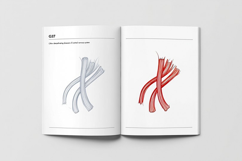 G37: ICD10 Code for Other demyelinating diseases of central nervous system