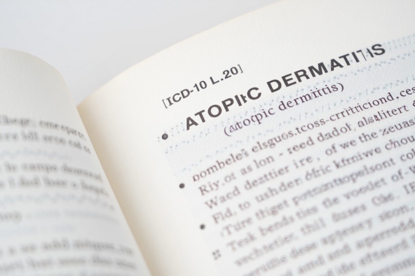 L20: ICD10 Code for Atopic dermatitis